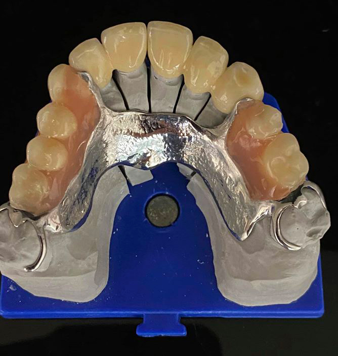 Réalisation d'une prothèse hybride | Chrome Labor SRL