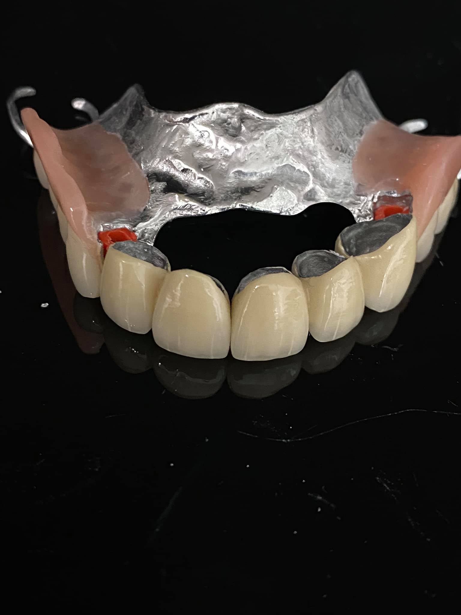 Réalisation d'une prothèse hybride | Chrome Labor SRL