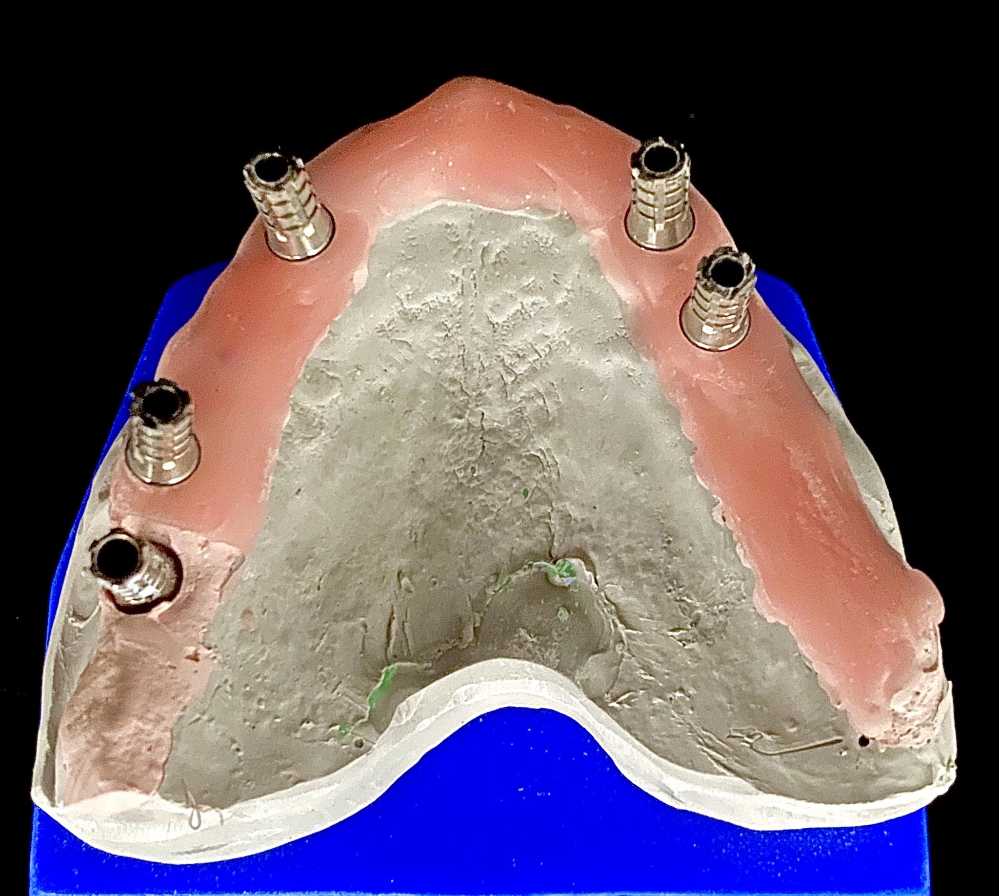 Reconstruction sur 5 implants | Chrome Labor SRL